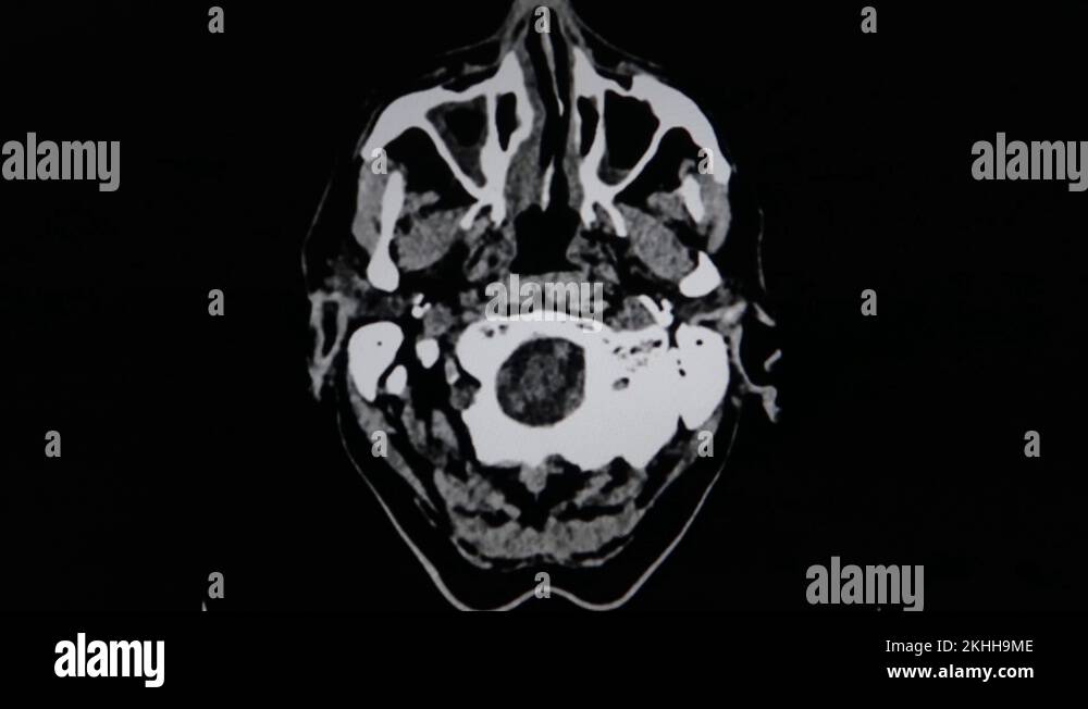 Ct scan brain injury Stock Videos & Footage - HD and 4K Video Clips - Alamy