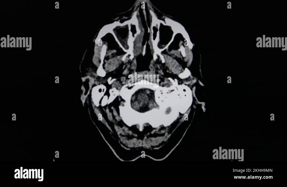 Mri of brain hemorrhage Stock Videos & Footage - HD and 4K Video Clips ...