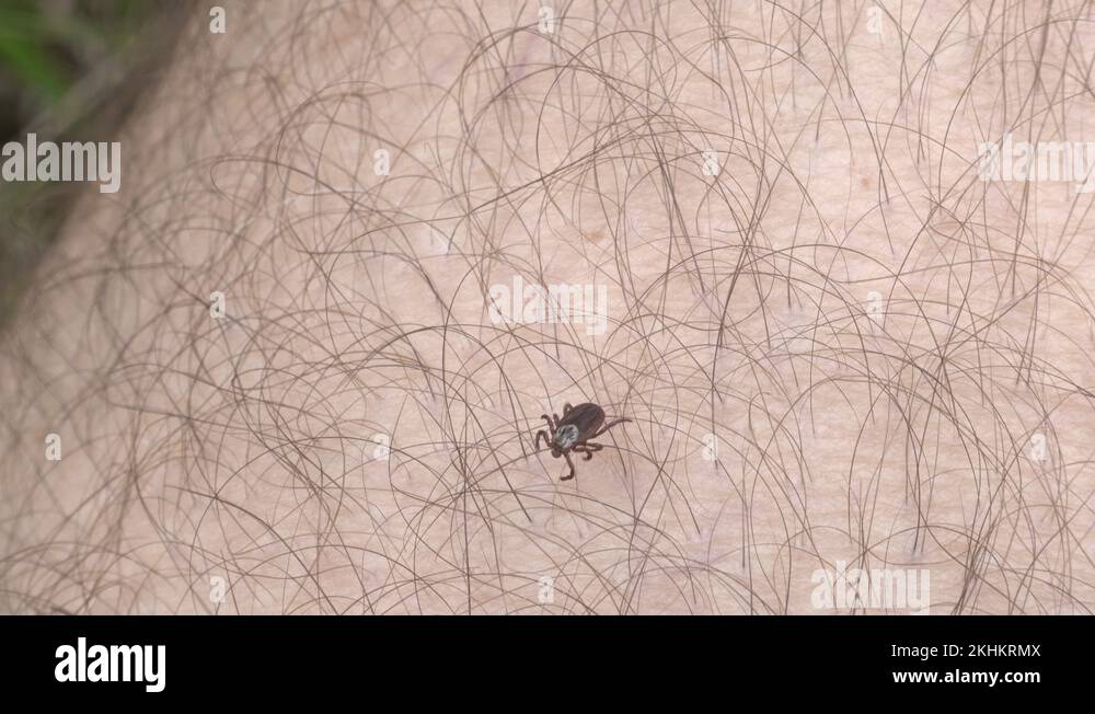 Tick (Dermacentor) on the human skin. Tick-borne disease vector. 4K ...