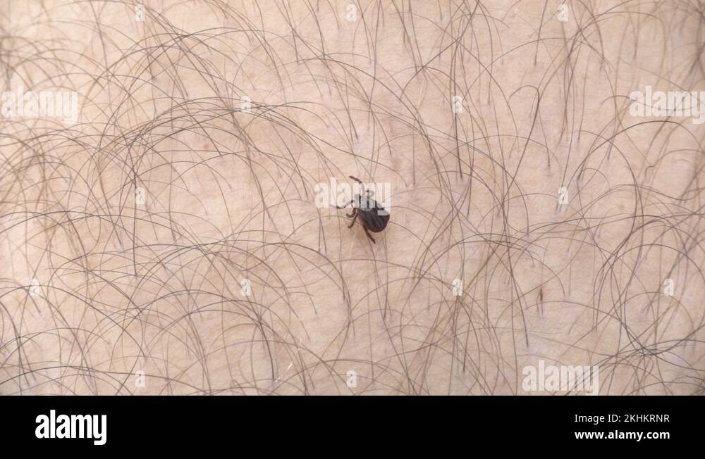 Tick on the human skin slow motion, 240 fps. Tick-borne disease vector ...