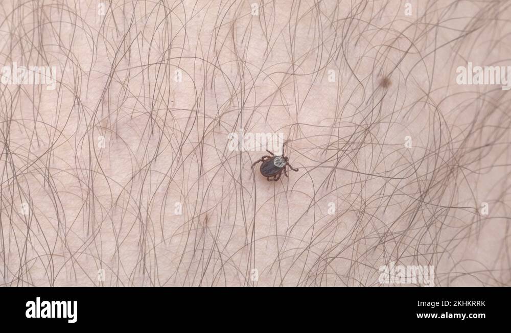 Tick on the human body. Tick crawling close up. 4K Stock Video Footage ...