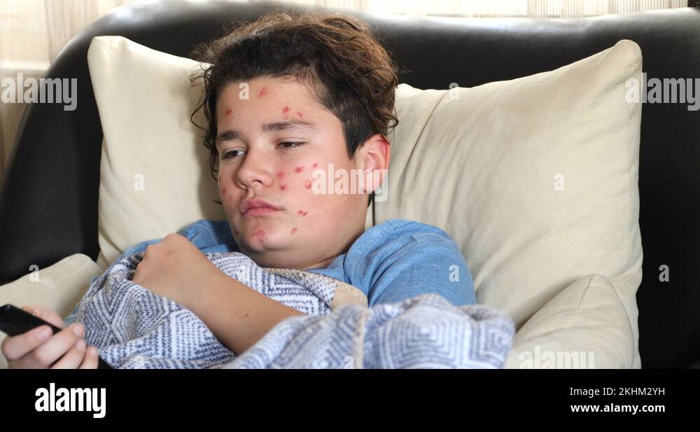 Pox smallpox pox Stock Videos & Footage - HD and 4K Video Clips - Alamy