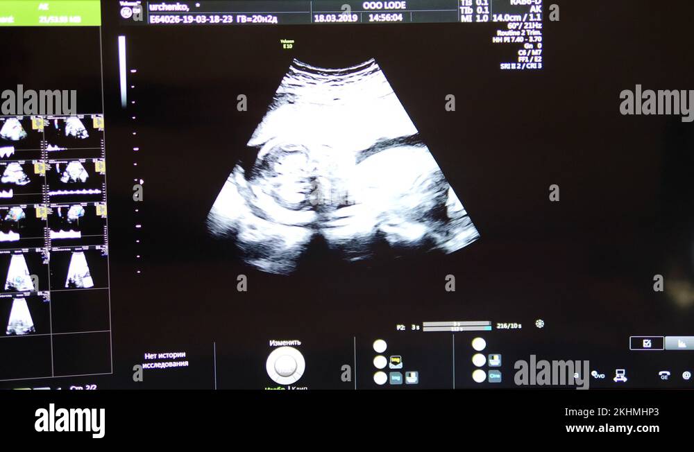 2D Ultrasound Display Of Pregnant. Fetus Ultrasound Image Shows Organs ...