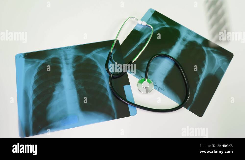 The x-rays photos of the lungs and Medical stethoscope or phonendoscope ...