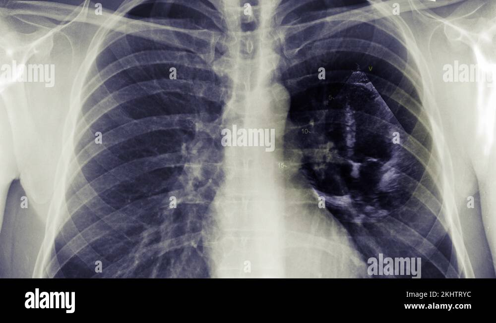 Rib cage heart and lungs Stock Videos & Footage - HD and 4K Video Clips ...