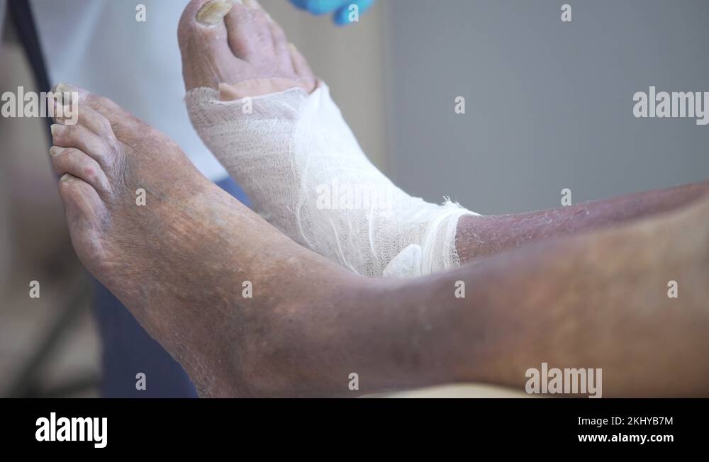 Varicose Veins, Sore Legs, blood Clot, Thrombophlebitis, trophic ulcers ...