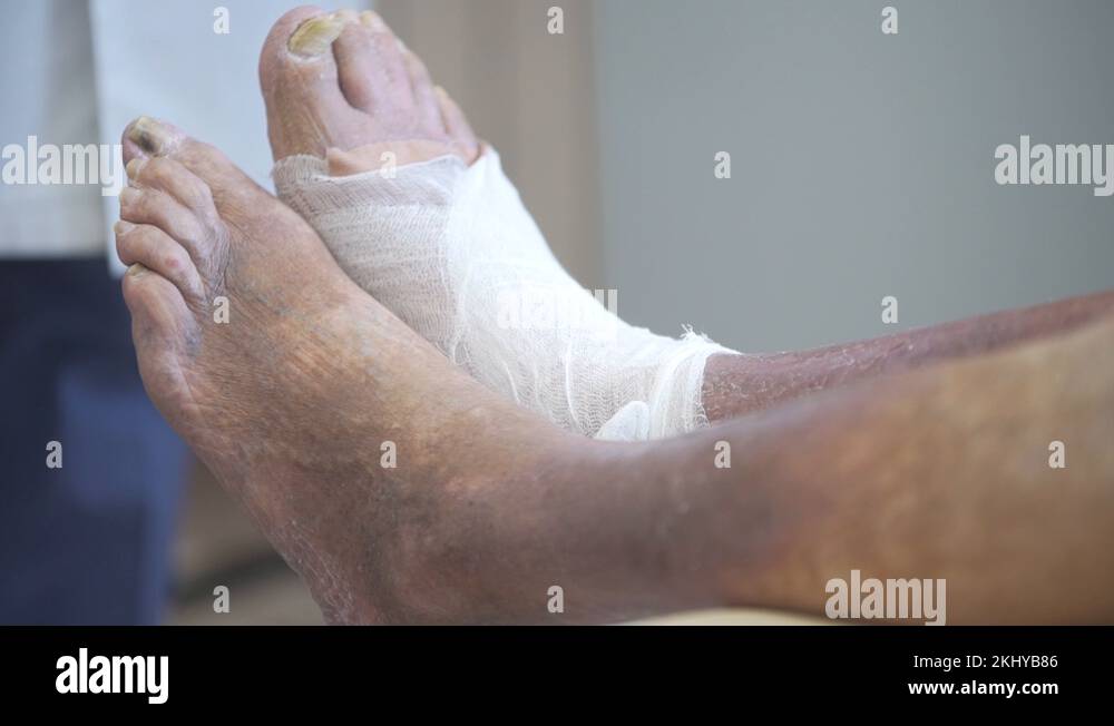 Varicose Veins, Sore Legs, blood Clot, Thrombophlebitis, trophic ulcers ...