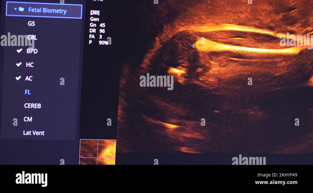 Fetal sonography Stock Videos & Footage - HD and 4K Video Clips - Alamy