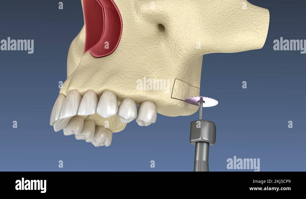 Lateral lift Stock Videos & Footage - HD and 4K Video Clips - Alamy