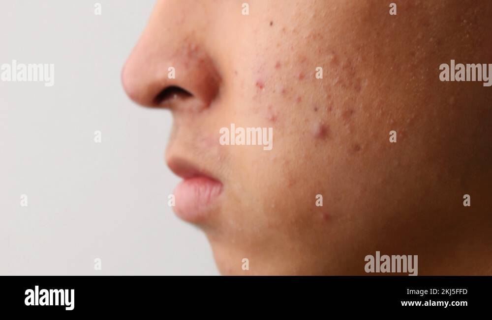 Close-up the side face of Asian teenage guy with acne and skin problems ...