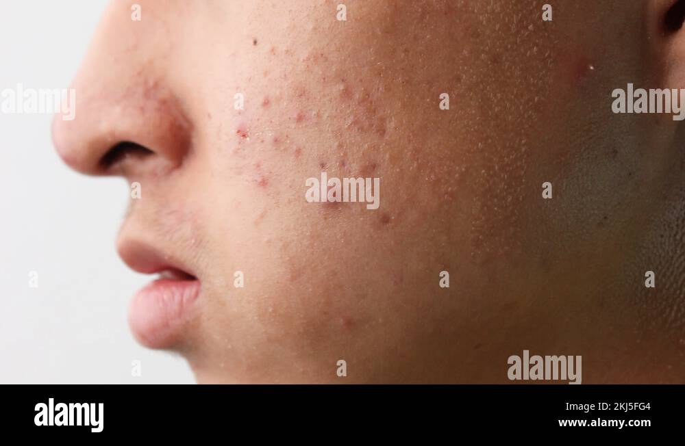 Close-up the side face of Asian teenage guy with acne and skin problems ...