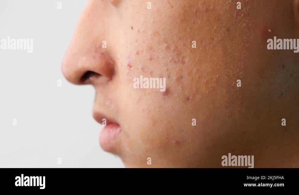 Close-up the side face of Asian teenage guy with acne and skin problems ...