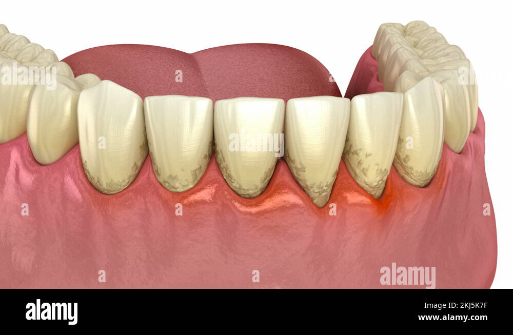 Gum periodontitis Stock Videos & Footage - HD and 4K Video Clips - Alamy