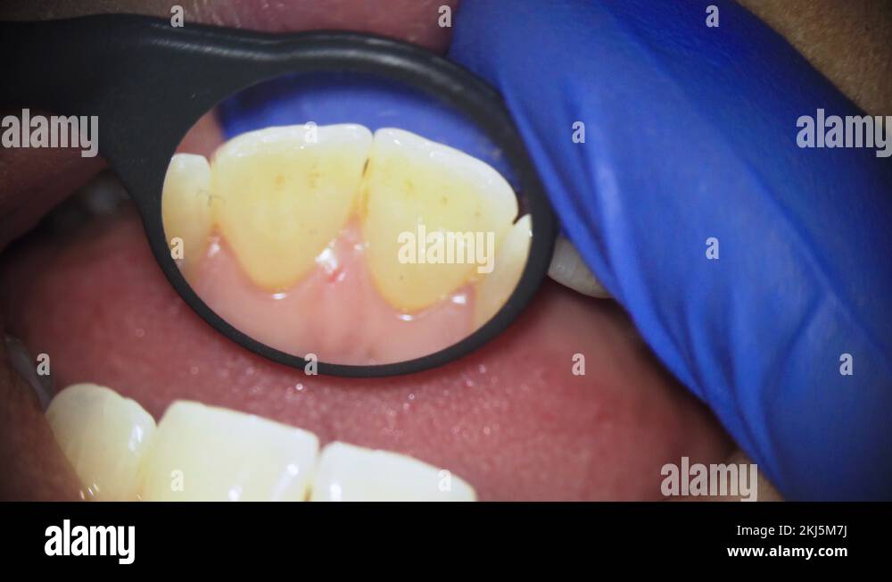 Angled teeth Stock Videos & Footage - HD and 4K Video Clips - Alamy