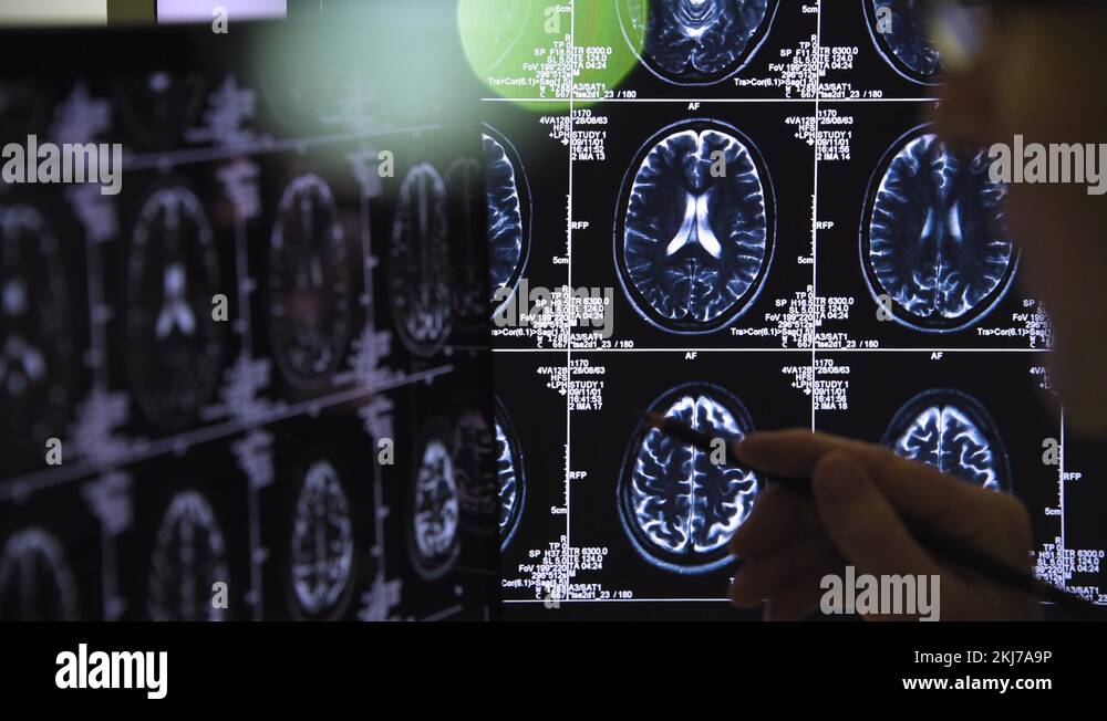 Doctor examining MRI brain scan Stock Video Footage - Alamy