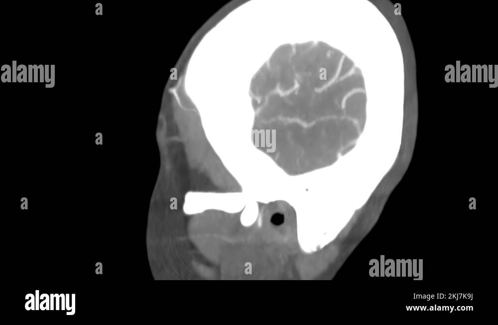 Angio Angiography MRI brain scan, Side view. Computed Tomography of the ...