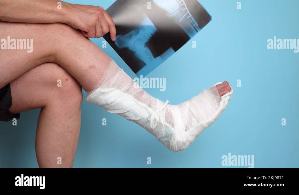 X ray of ankle fracture Stock Videos & Footage - HD and 4K Video Clips ...