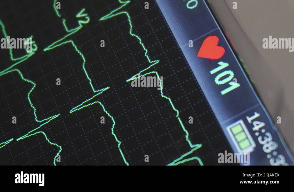 Ecg machine screen Stock Videos & Footage - HD and 4K Video Clips - Alamy