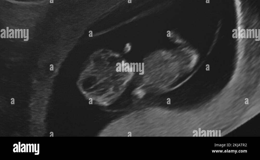 Fetus at 10 weeks Stock Videos & Footage - HD and 4K Video Clips - Alamy