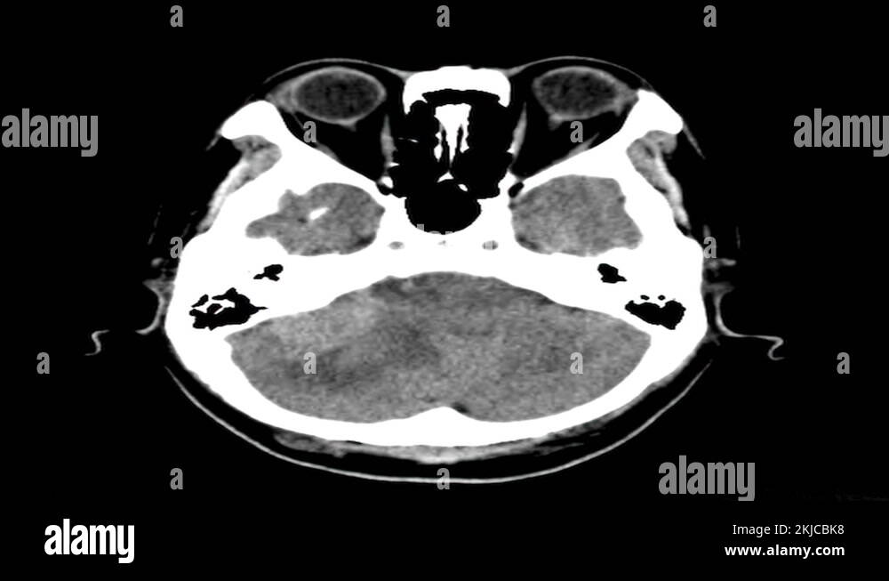 Brain neoplasm Stock Videos & Footage - HD and 4K Video Clips - Alamy