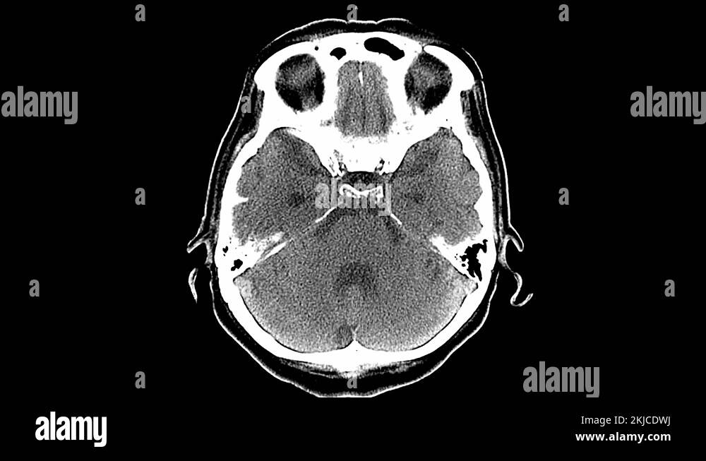 Ct brain not mri Stock Videos & Footage - HD and 4K Video Clips - Alamy