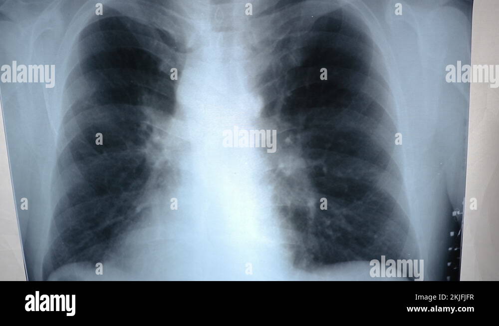 Healthy lungs chest x ray Stock Videos & Footage - HD and 4K Video ...