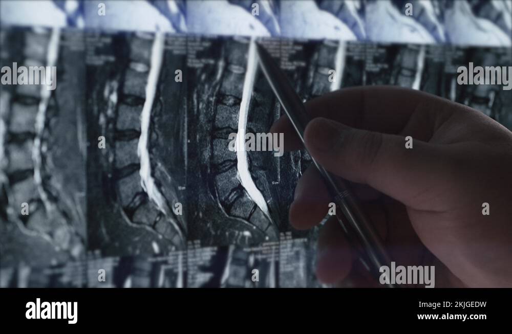 Lumbar Mri Stock Videos And Footage Hd And 4k Video Clips Alamy