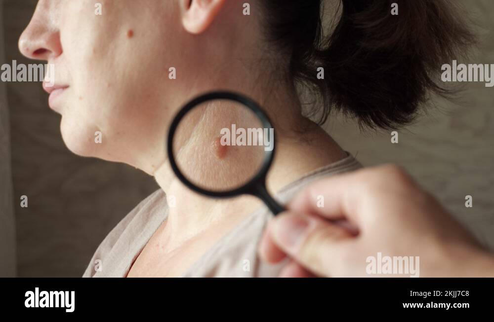 Dermatologist examines a mole on the patient's neck using a magnifying ...