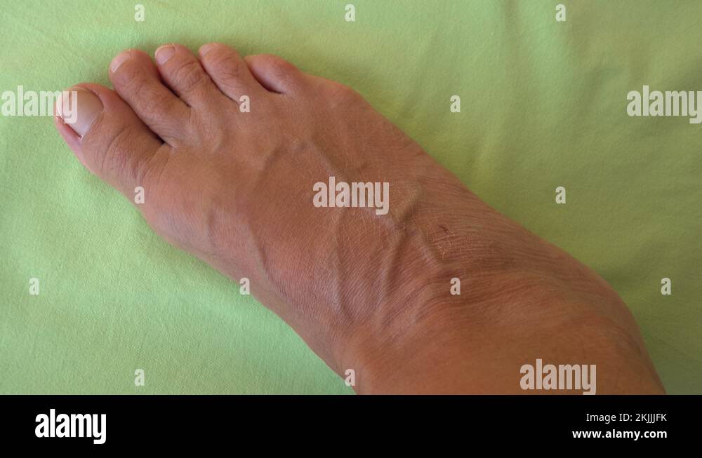 Green screen Female right foot with outstanding veins and dry skin ...