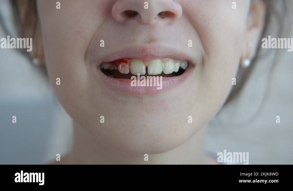 Pulled tooth blood Stock Videos & Footage - HD and 4K Video Clips - Alamy