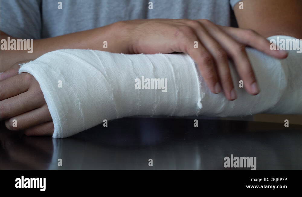 Broken arm and wrist in plaster Stock Videos & Footage - HD and 4K ...