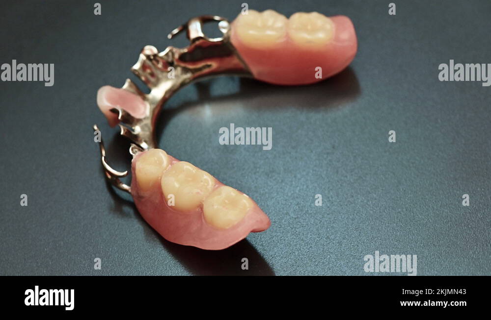 Removable partial denture metal plastic Stock Videos & Footage - HD and ...