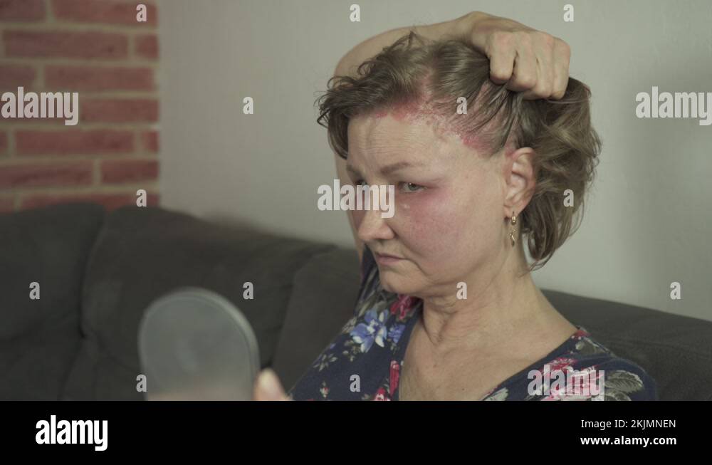 Allergy on the scalp after hair coloring. Swollen face. Skin Reaction ...