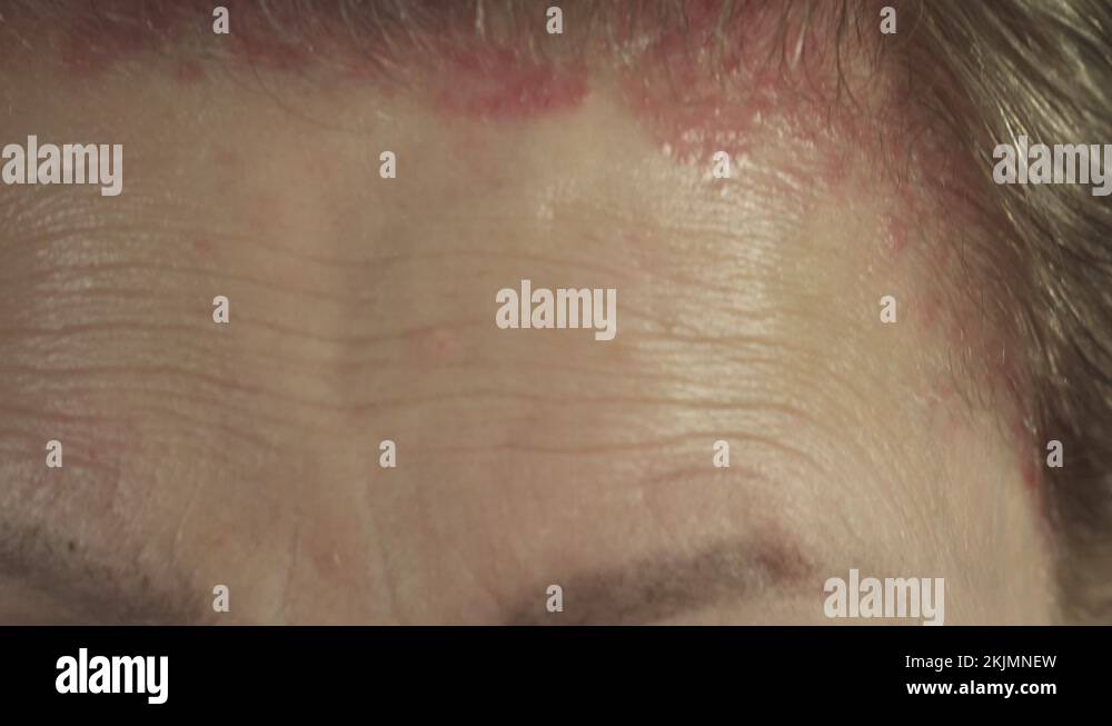 Allergy on the scalp after hair coloring. Swollen face. Skin Reaction ...