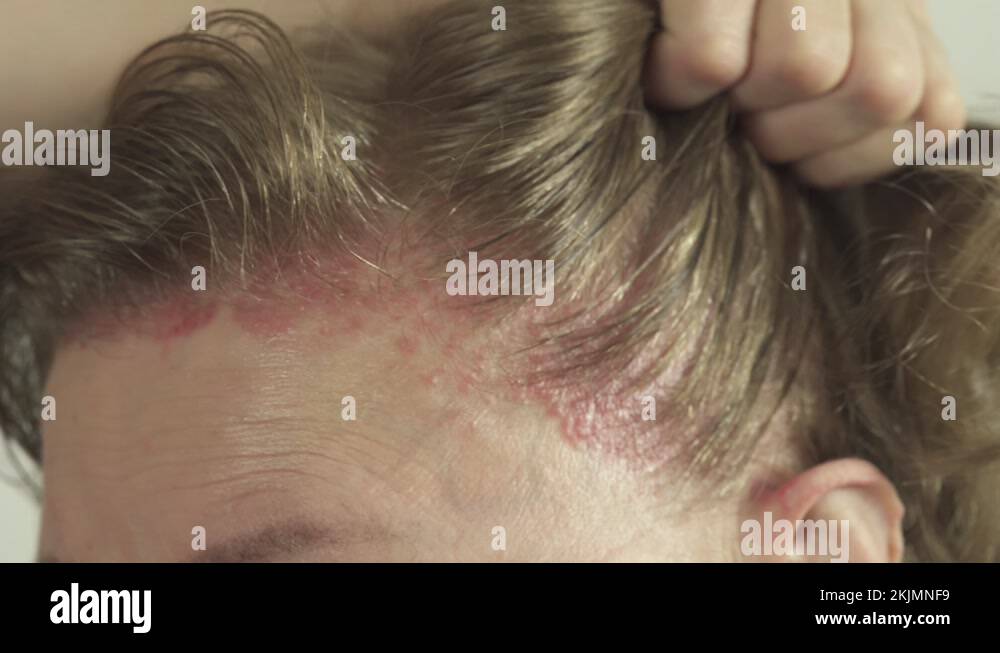 Allergy on the scalp after hair coloring. Swollen face. Skin Reaction ...