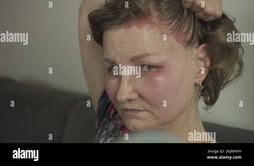 Skin reaction face Stock Videos & Footage - HD and 4K Video Clips - Alamy