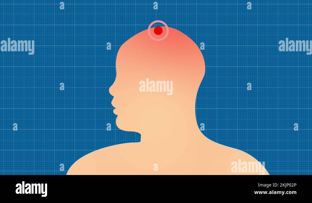Migraine headache animation. Place of pain on a human silhouette Stock ...