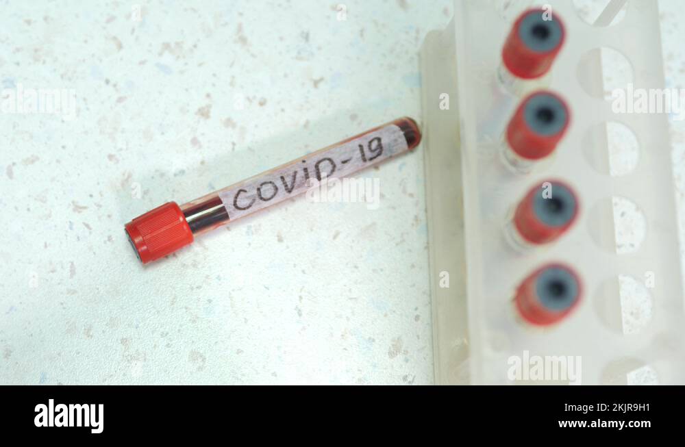 Positive COVID-19 test and laboratory sample of blood testing for ...