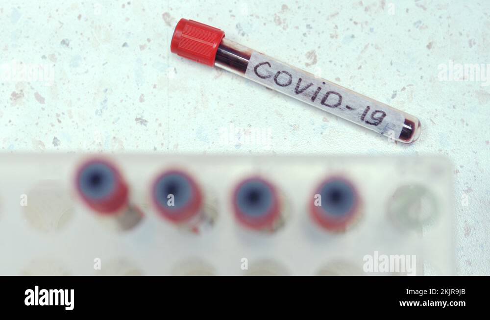 Positive COVID-19 test and laboratory sample of blood testing for ...