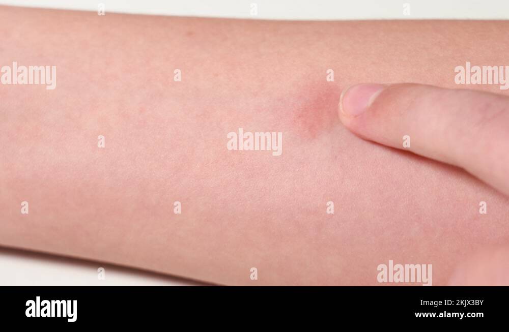 Allergy test reaction Stock Videos & Footage - HD and 4K Video Clips ...