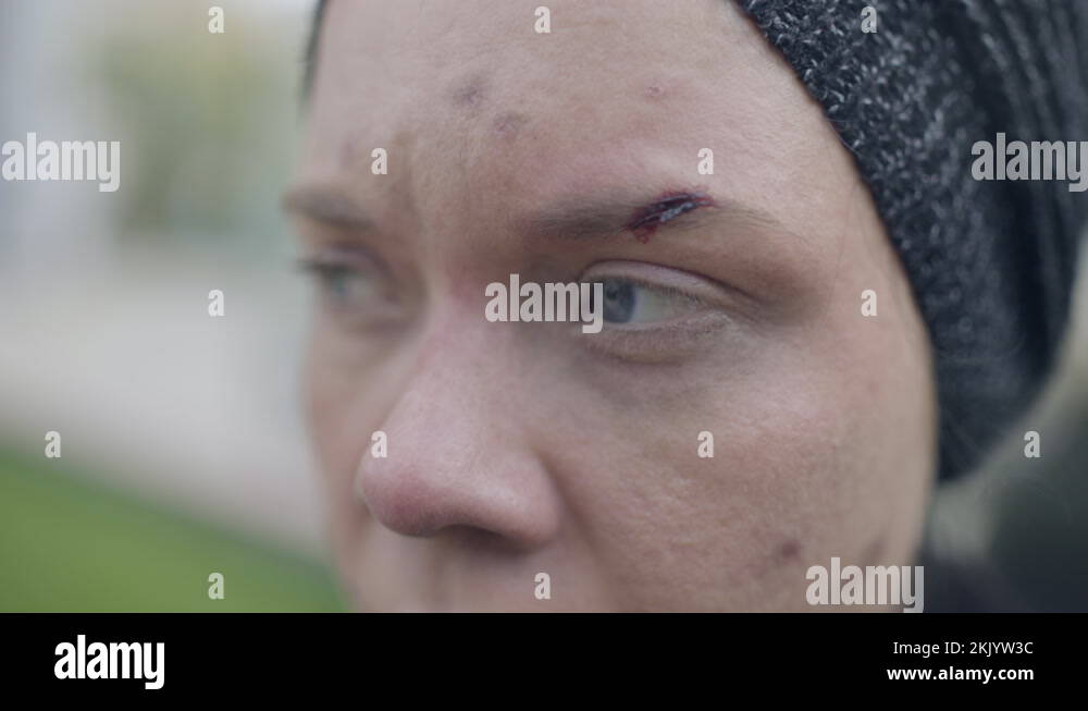 Dizzy woman with wound on the face, substance abuse, drug intoxication ... Dizzy woman with wound on the face, substance abuse, drug intoxication ...