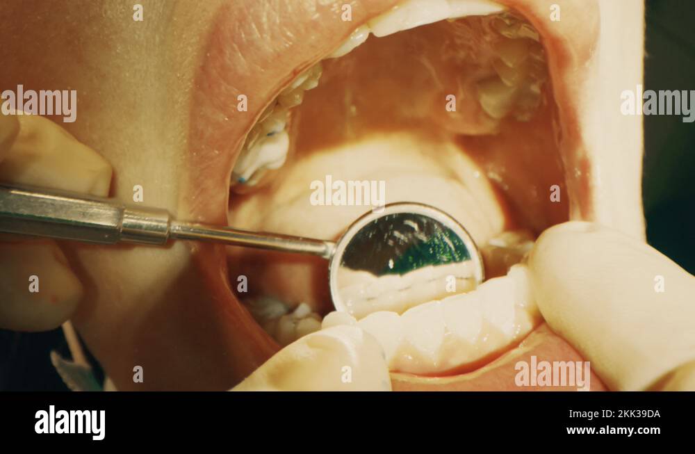 Dental retainers Stock Videos & Footage - HD and 4K Video Clips - Alamy