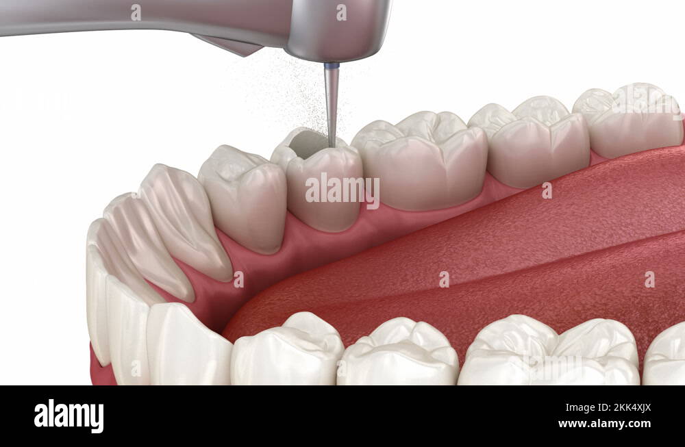 Endodontic therapy Stock Videos & Footage - HD and 4K Video Clips - Alamy