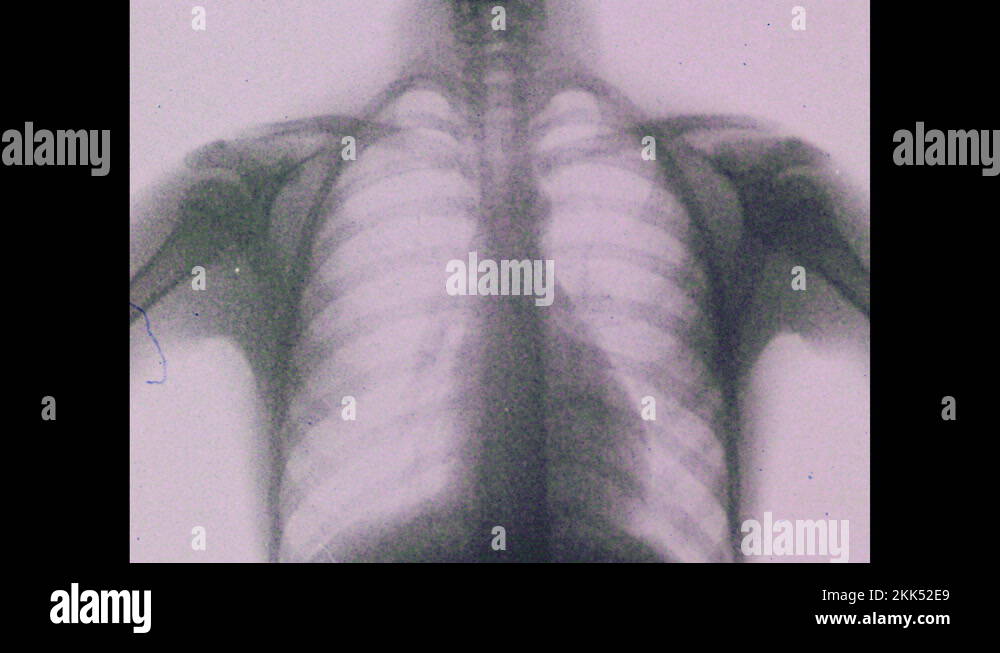 Chest arteries Stock Videos & Footage - HD and 4K Video Clips - Alamy