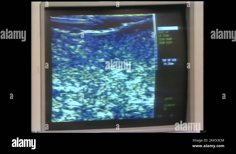 1990s: Computer graphics on screen. Men with patient by computer, zoom ...