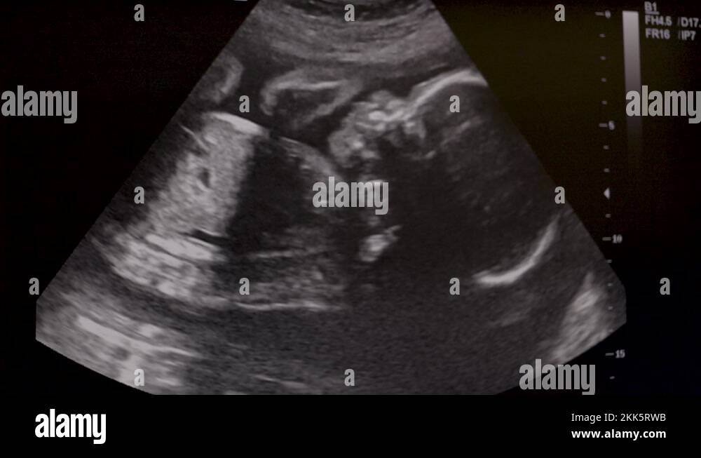 Embryo uterus Stock Videos & Footage - HD and 4K Video Clips - Alamy