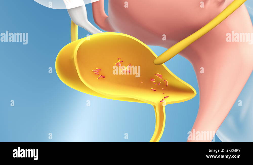 Urinary tract infection bacteria Stock Videos & Footage - HD and 4K ...