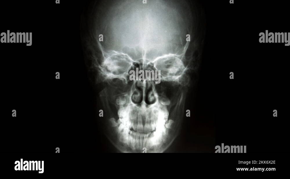 Zoom-in X-ray of a human skull, human bones. 4K Stock Video Footage - Alamy