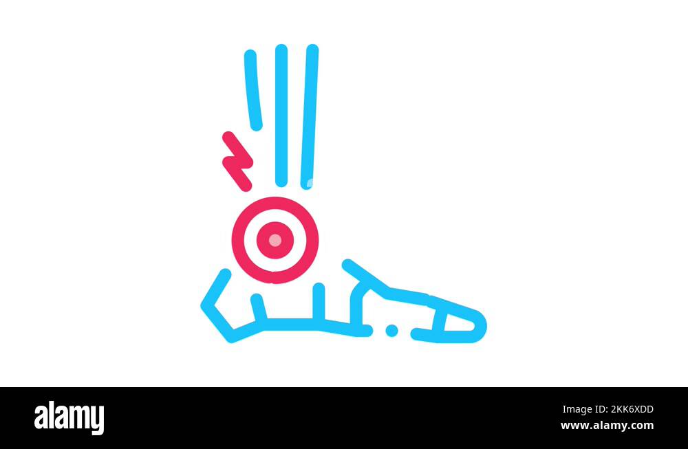 Rheumatoid arthritis x ray foot Stock Videos & Footage - HD and 4K ...