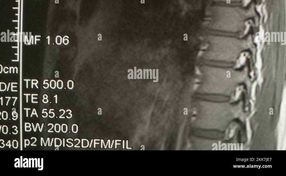 Herniated lumbar disc mri Stock Videos & Footage - HD and 4K Video ...